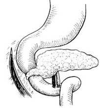 Pâncreas anular - Pages [2] - Conhecimento enciclopédico Mundo